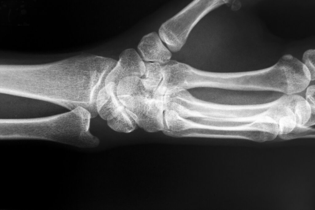 Redmond Bone Fractures Lawyer - Washington Injury Lawyer